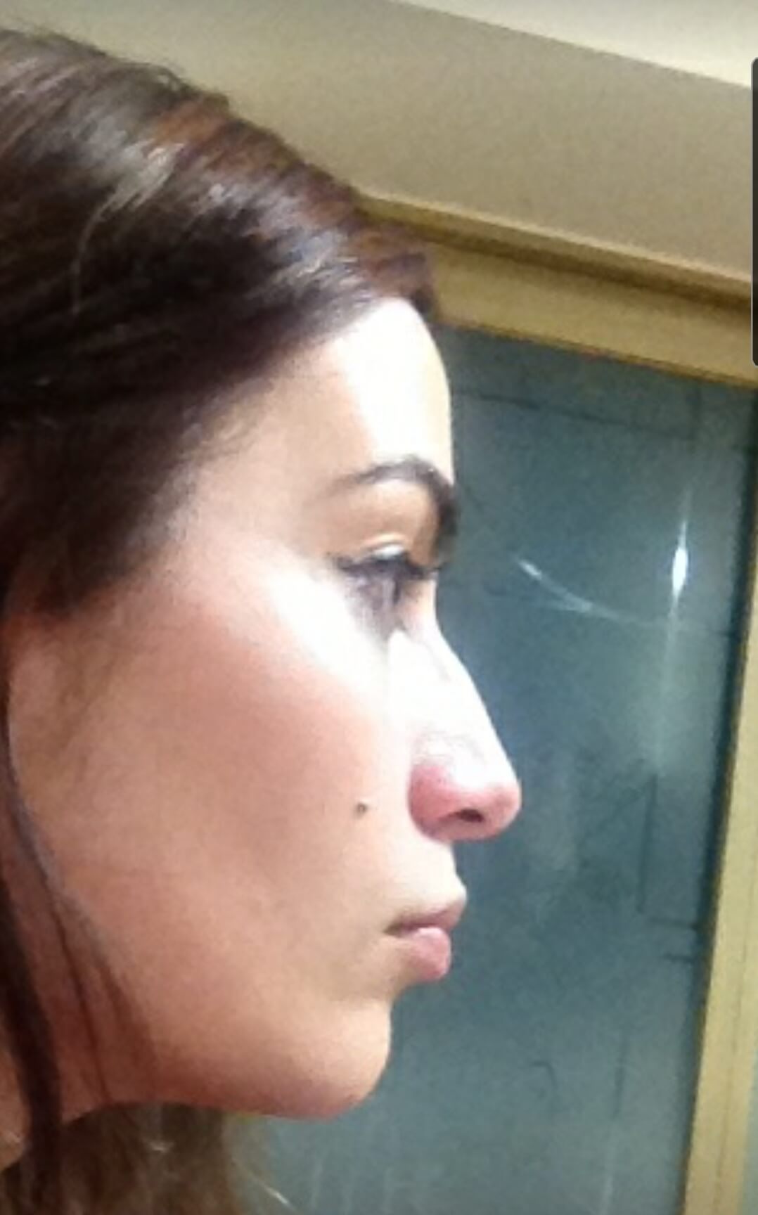 Nose Job and Revision Rhinoplasty in South Korea: My Story – Beauty Bap